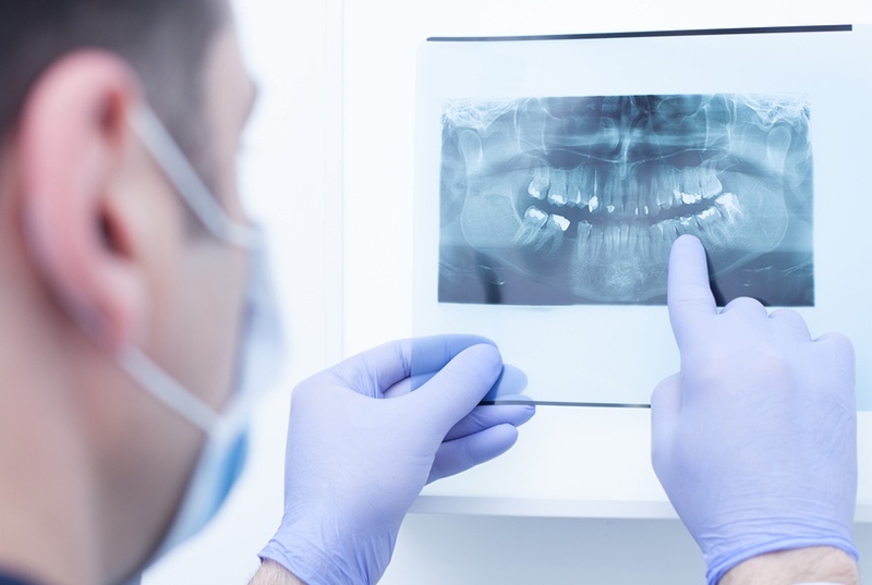 عکس opg دندان، ابزاری حیاتی برای تشخیص مشکلات پنهان دندان